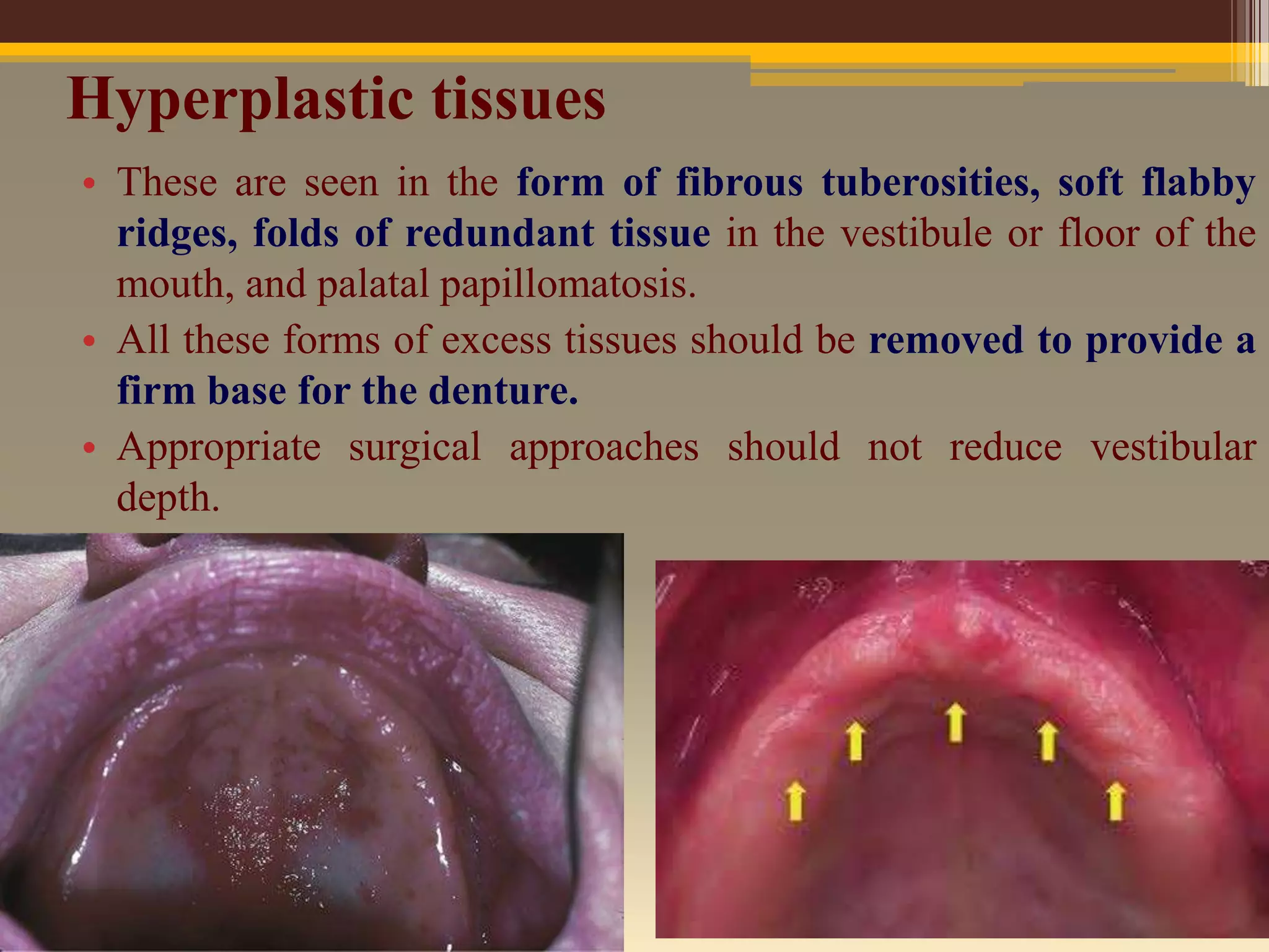 mouth preparation for rpd (2).pptx