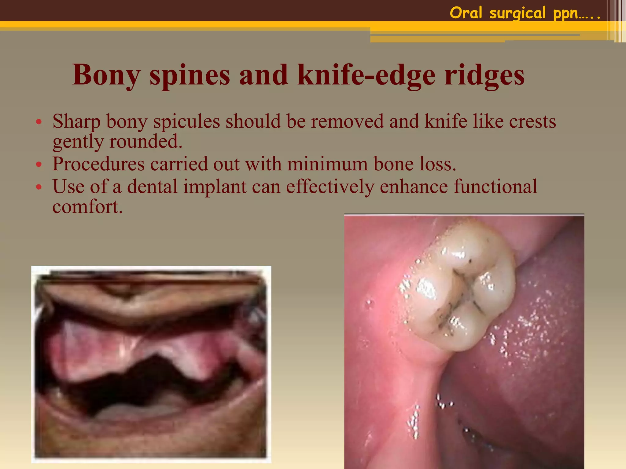 mouth preparation for rpd (2).pptx