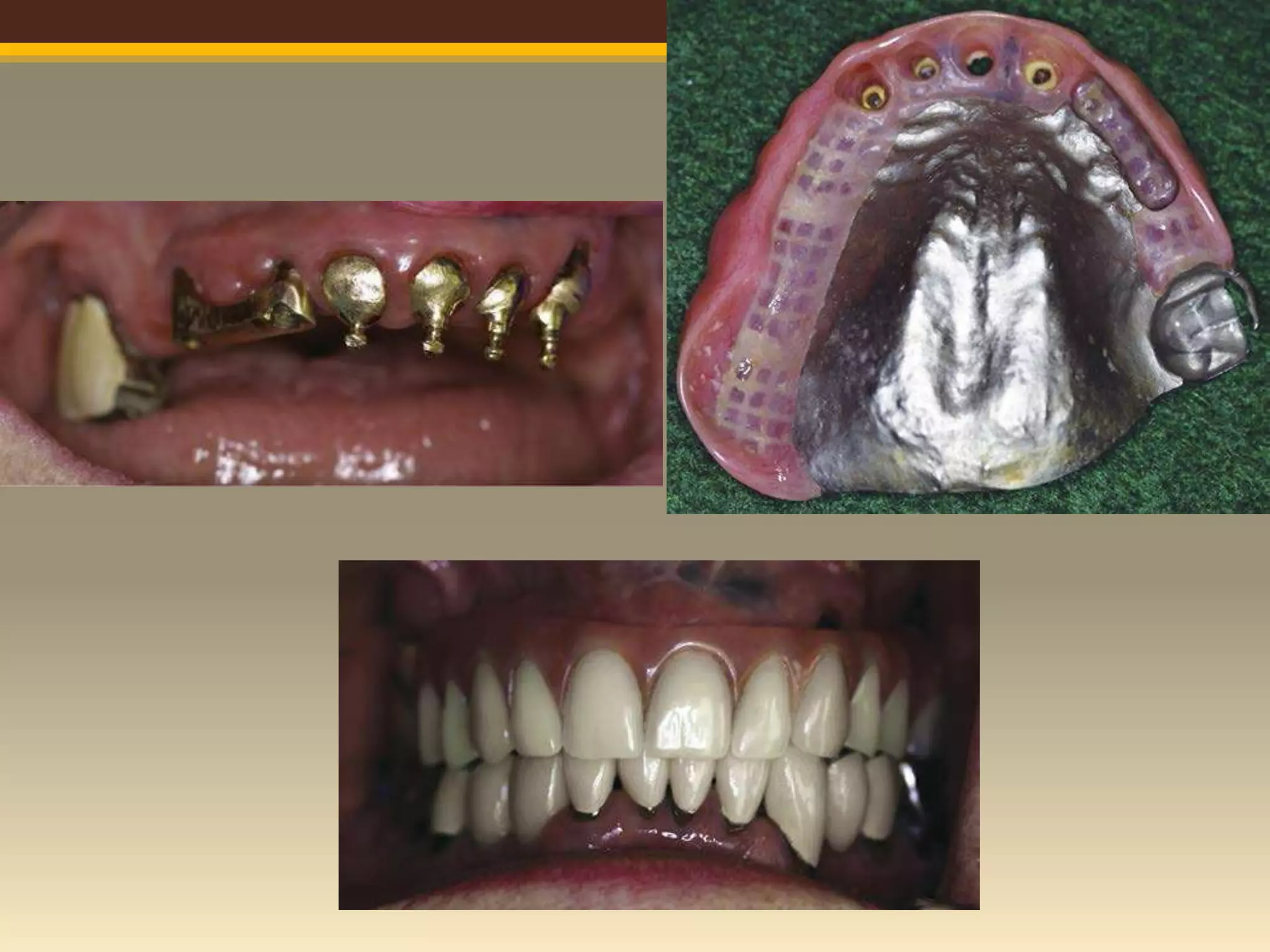 mouth preparation for rpd (2).pptx