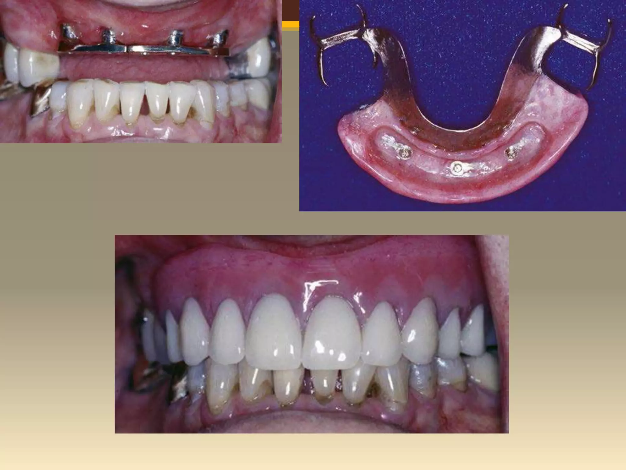 mouth preparation for rpd (2).pptx