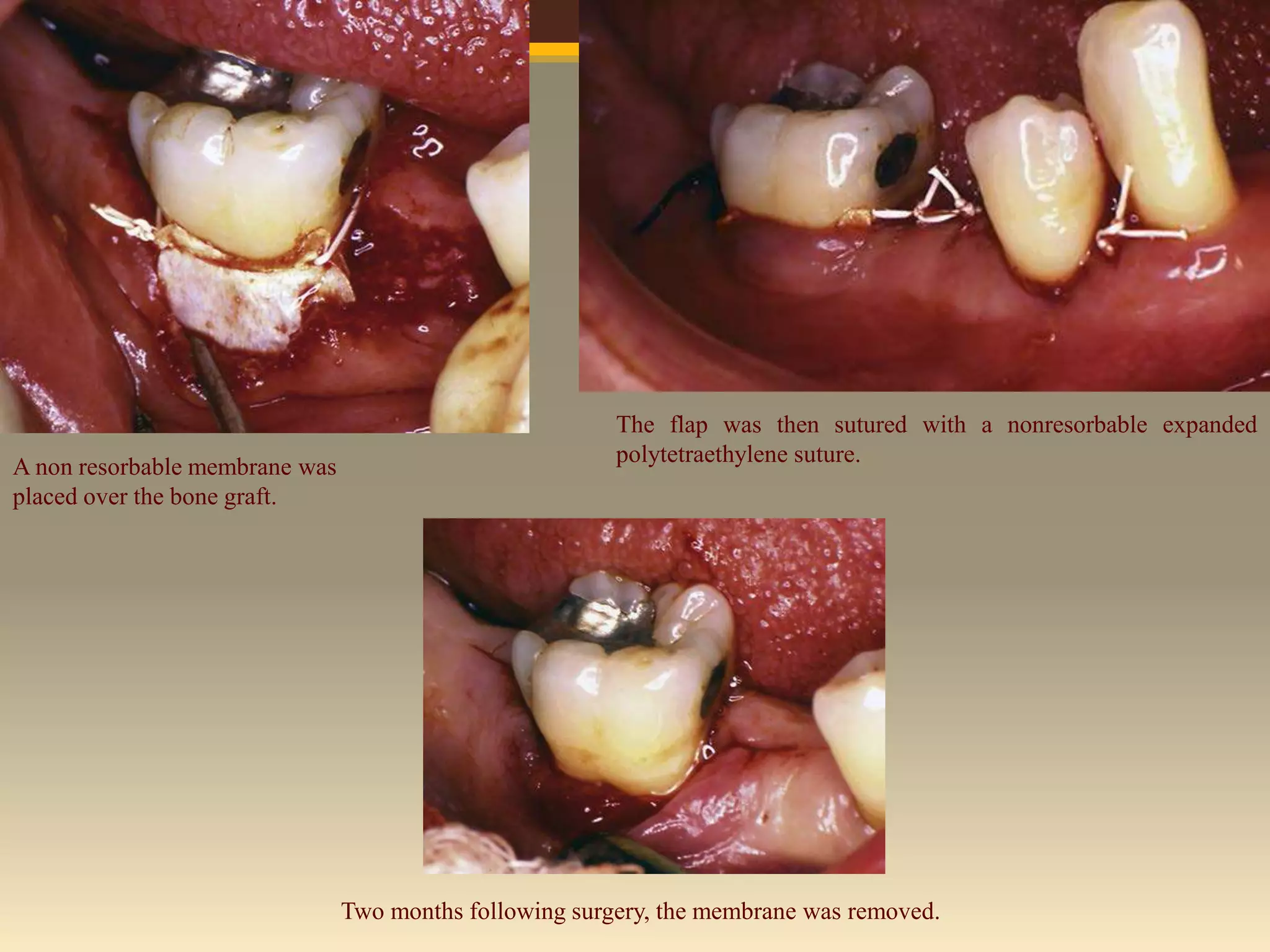mouth preparation for rpd (2).pptx