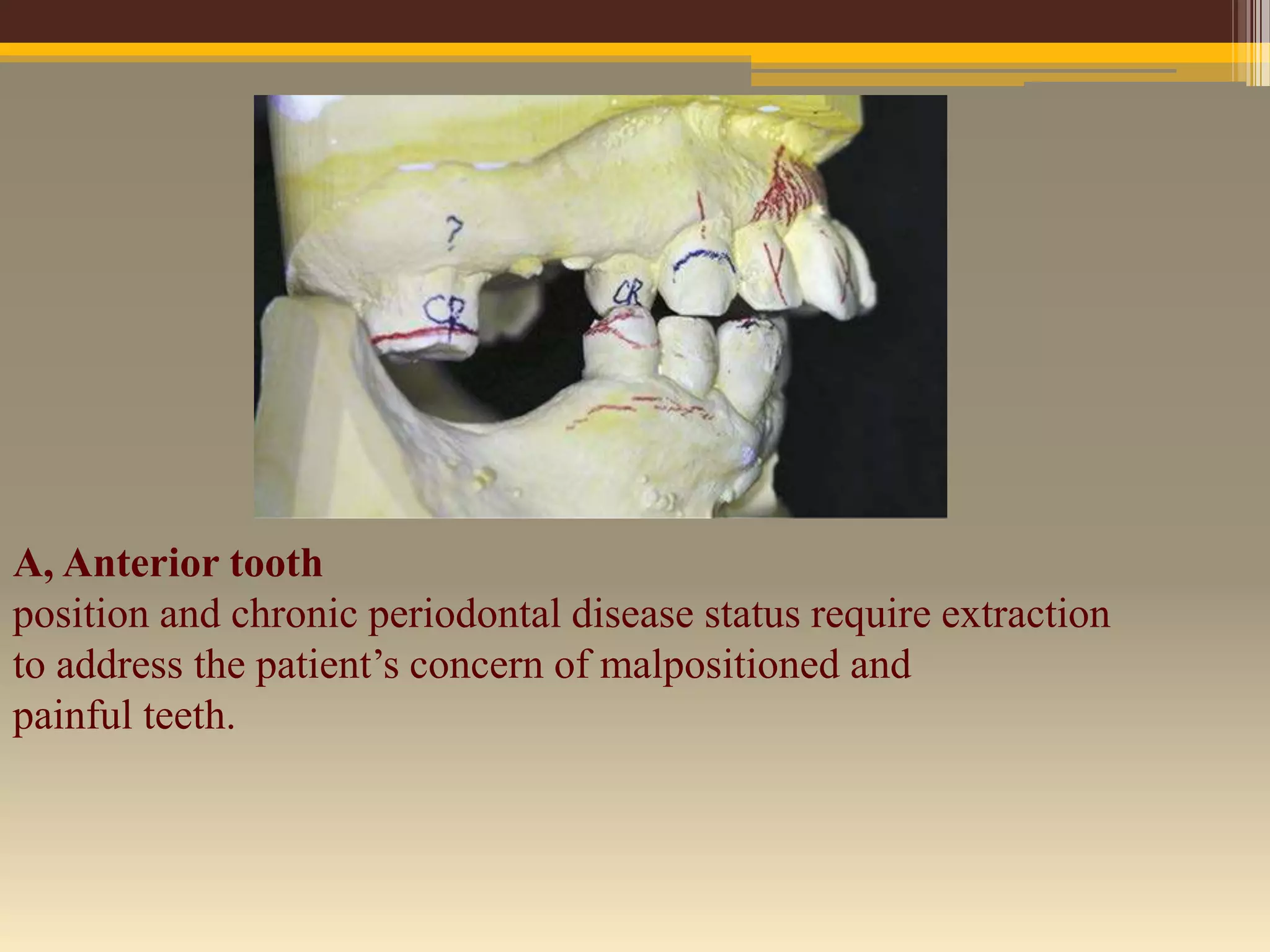 mouth preparation for rpd (2).pptx