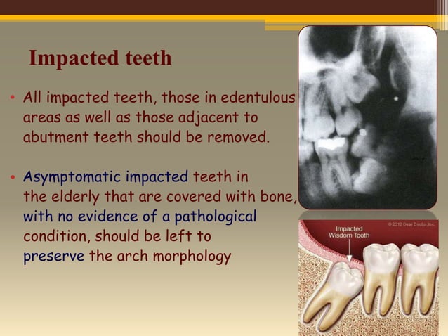 mouth preparation for rpd (2).pptx | Dental Health | Diseases and ...