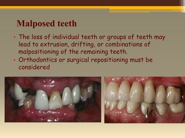 mouth preparation for rpd (2).pptx | Dental Health | Diseases and ...