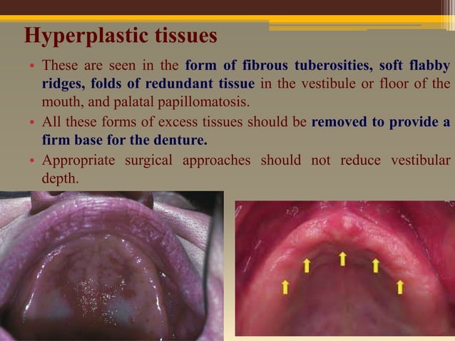 mouth preparation for rpd (2).pptx | Dental Health | Diseases and ...