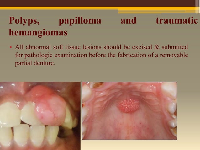 mouth preparation for rpd (2).pptx | Dental Health | Diseases and ...