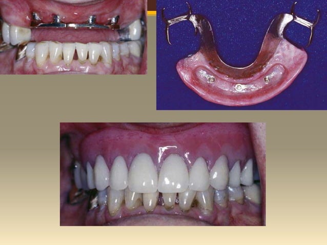 mouth preparation for rpd (2).pptx | Dental Health | Diseases and ...