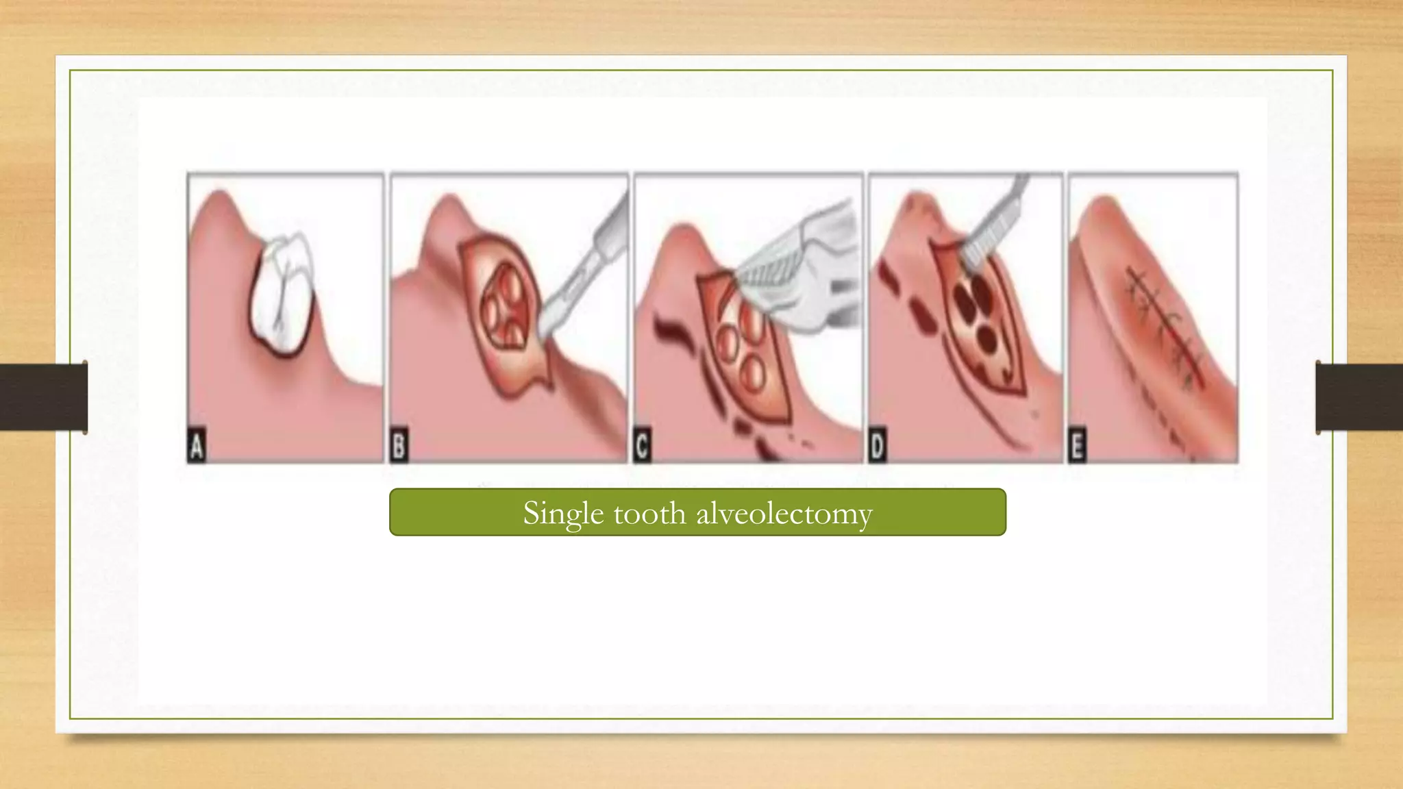 Mouth Preparation In Complete Dentures.pptx