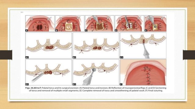 Mouth Preparation In Complete Dentures.pptx