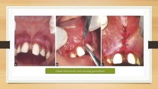 Mouth Preparation In Complete Dentures.pptx