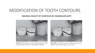 MOUTH PREPARATION IN CAST PARTIAL DENTURES | PPTX