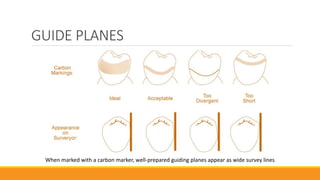 MOUTH PREPARATION IN CAST PARTIAL DENTURES | PPTX