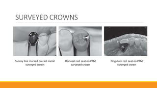 MOUTH PREPARATION IN CAST PARTIAL DENTURES | PPT
