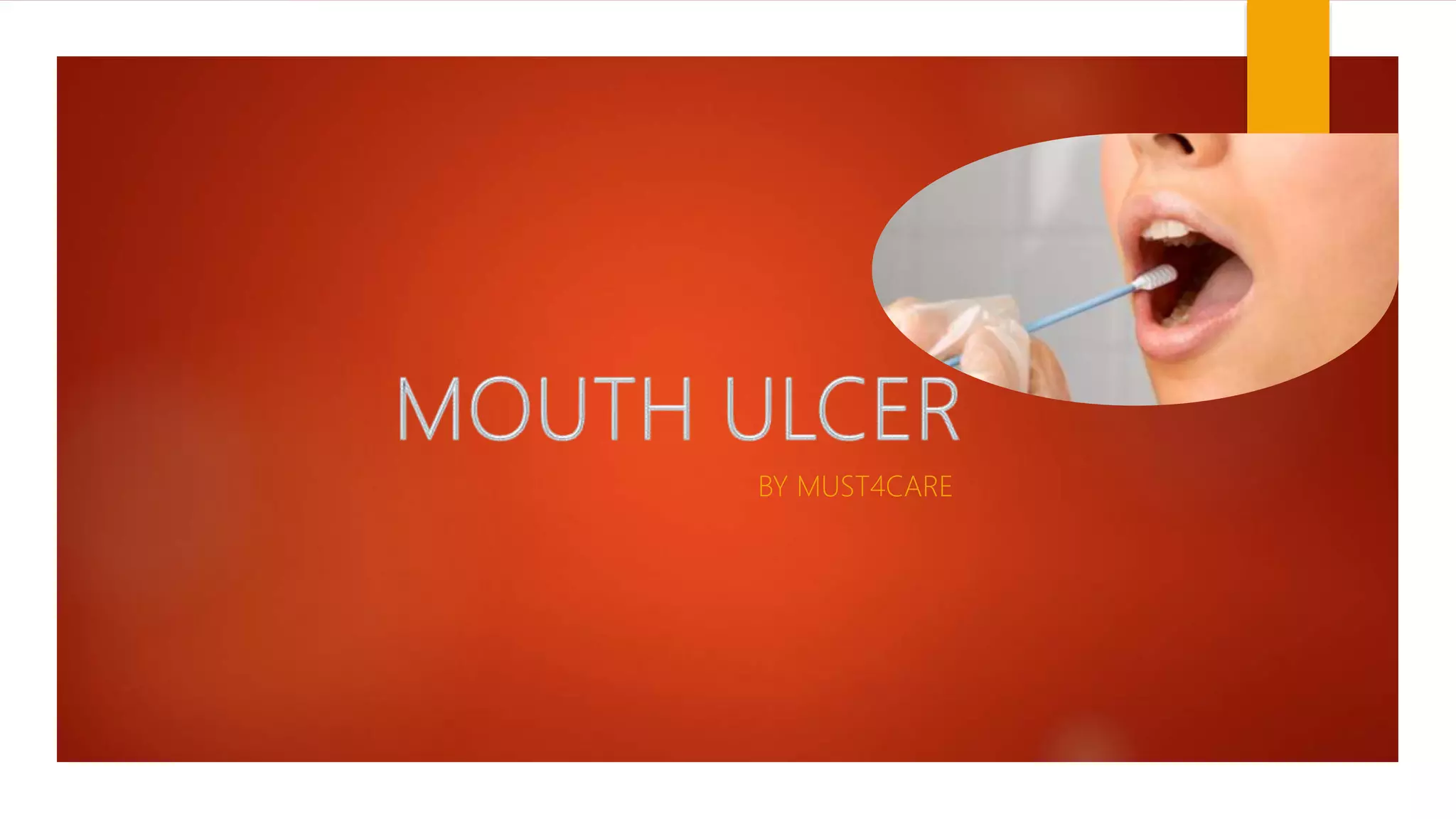 Mouth Ulcer And Cure Ppt