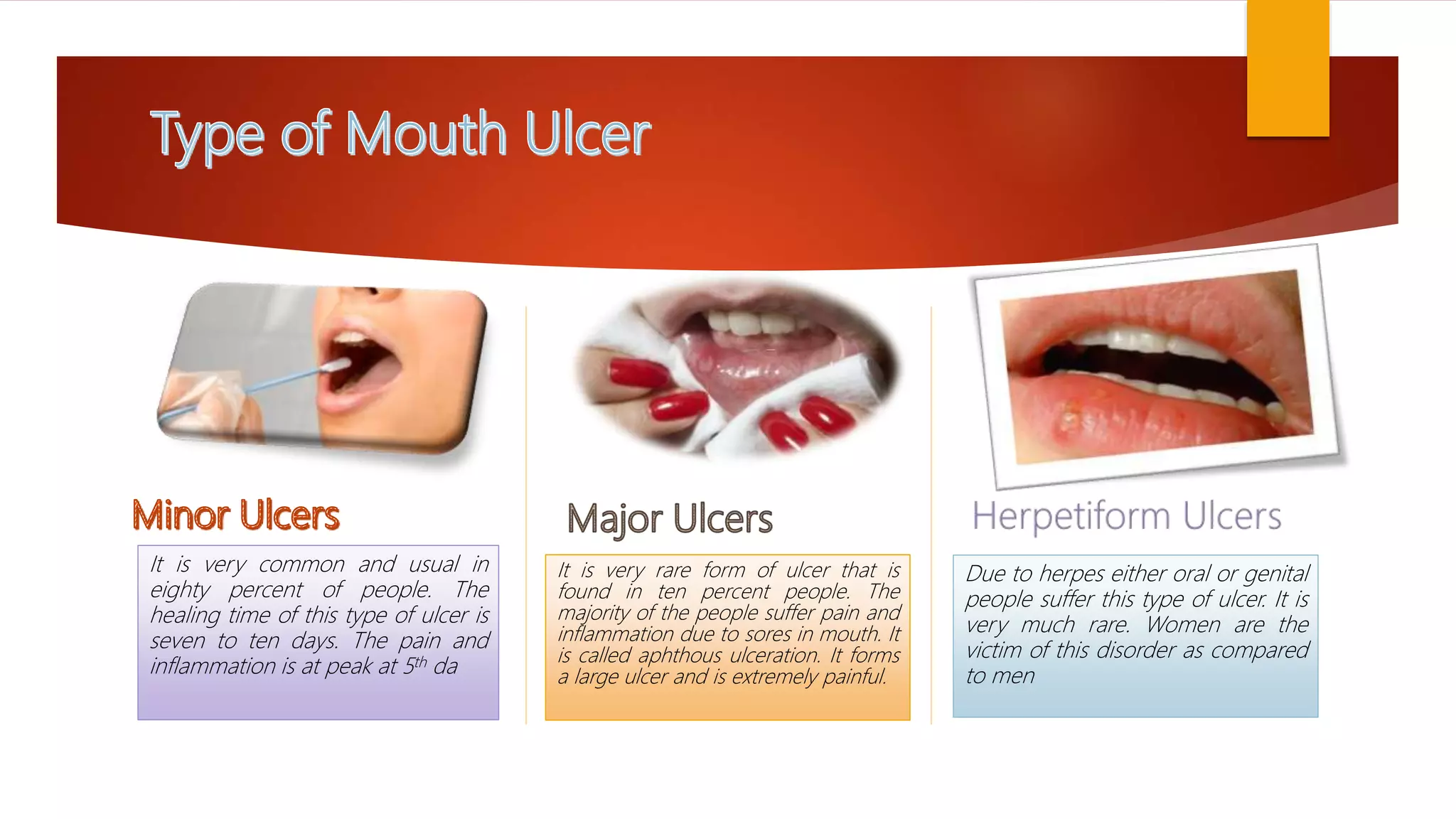 Mouth Ulcer and Cure | PPTX