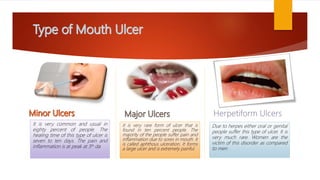 Mouth Ulcer and Cure | PPTX