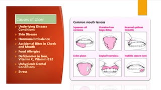 Mouth Ulcer and Cure | PPTX