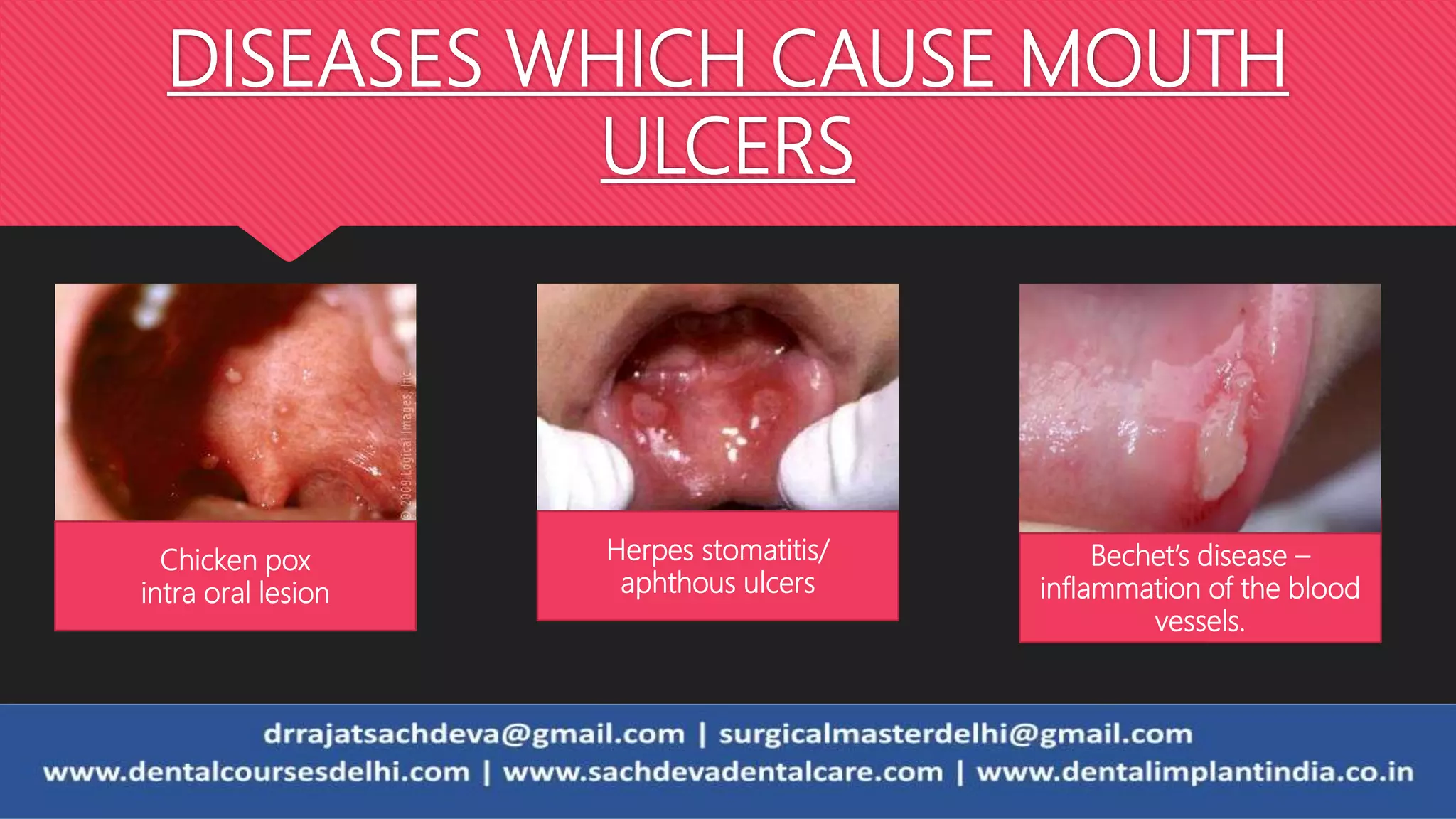 Mouth ulcers/canker sores | PPTX