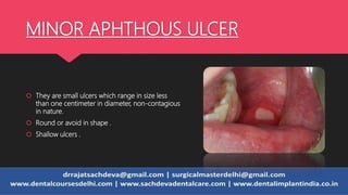 Mouth ulcers/canker sores | PPTX