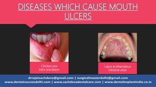 Mouth ulcers/canker sores | PPTX