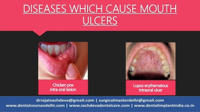 Mouth ulcers/canker sores