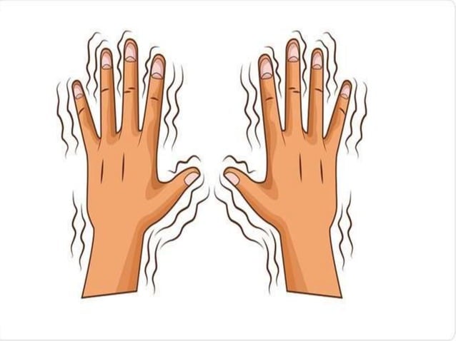 Movement disorder - HUNTINGTON'S DISEASE(Chorea) | PPTX | Physical ...