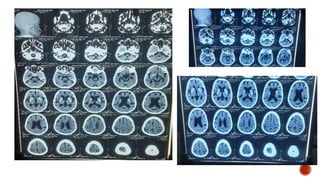 MOVEMENT DISORDER FULL chbg hypertension hyperglycemia.pptx