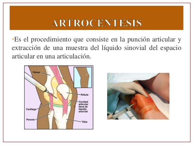 Movilidad artrocentesis