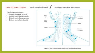 Movimientos Anormales: Coreas, Distonias Focales,Segmentarias y ...