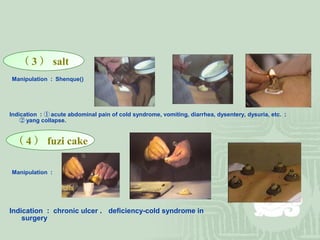 Moxibustion | PPT