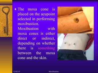 Moxibustion | PPT