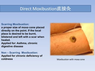 Moxibustion Therapy | PPTX