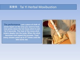 Moxibustion Therapy | PPT