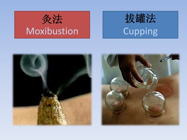 Moxibustion Therapy | PPT
