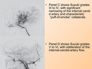 Moyamoya Disease | PPT
