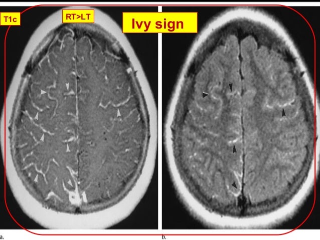 Moyamoya disease