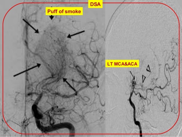 Moyamoya disease