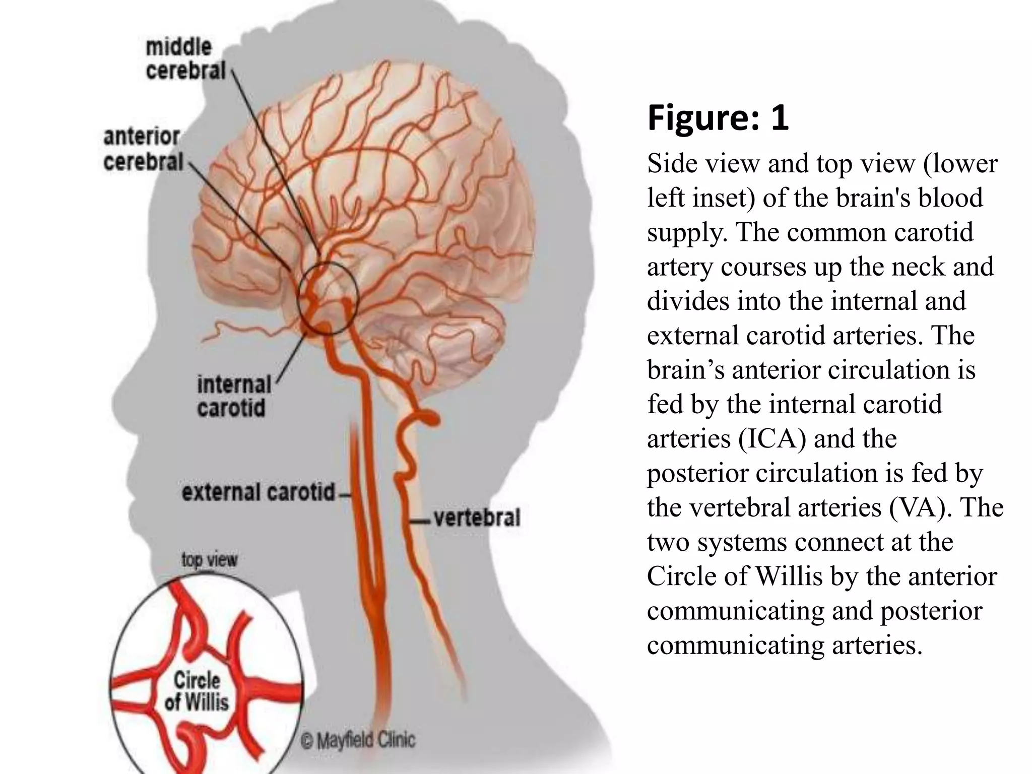 Moya moya disease | PPTX
