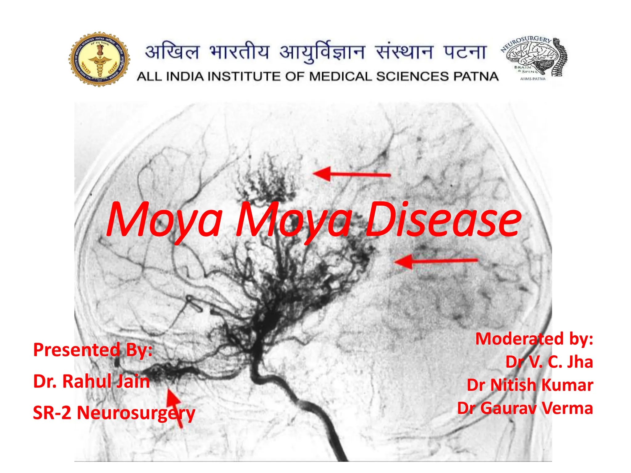 Moya Moya disease (vasculopathy/angiopathy) | PPTX Moya Moya disease (vasculopathy/angiopathy) | PPTX