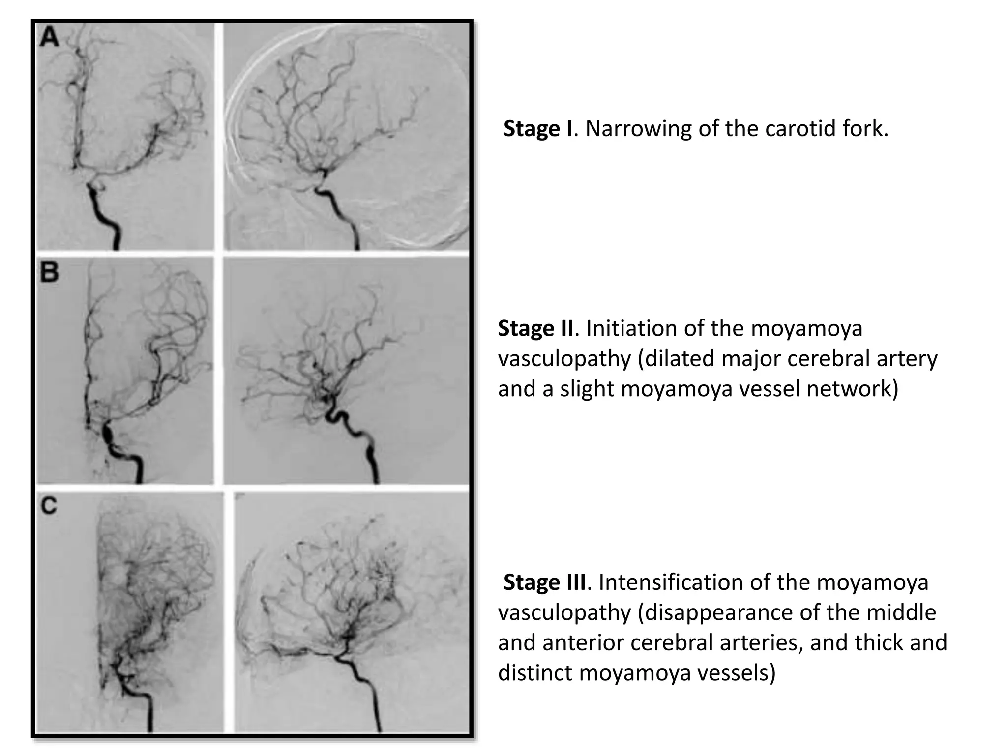 Moya Moya disease (vasculopathy/angiopathy) | PPTX