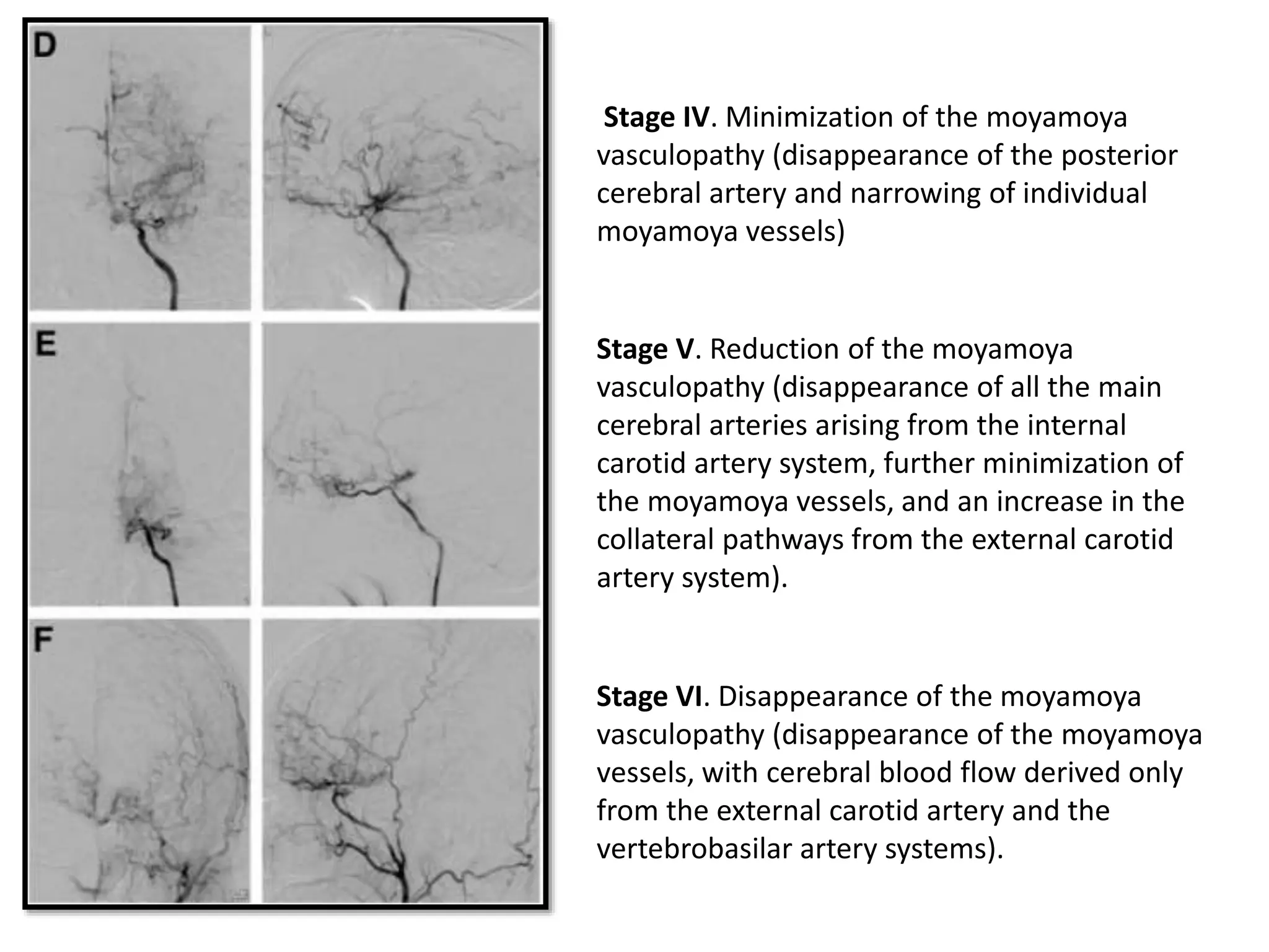 Moya Moya disease (vasculopathy/angiopathy) | PPTX