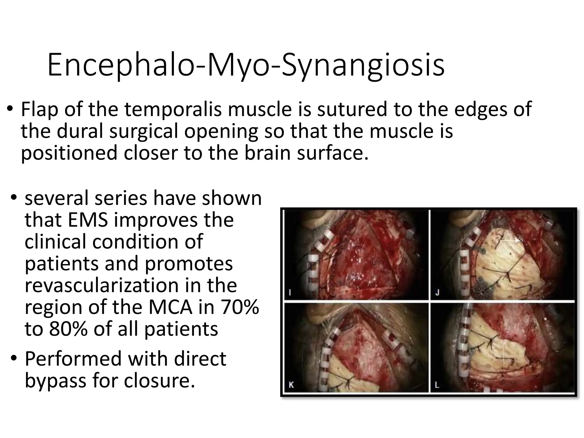 Moya Moya disease (vasculopathy/angiopathy) | PPTX