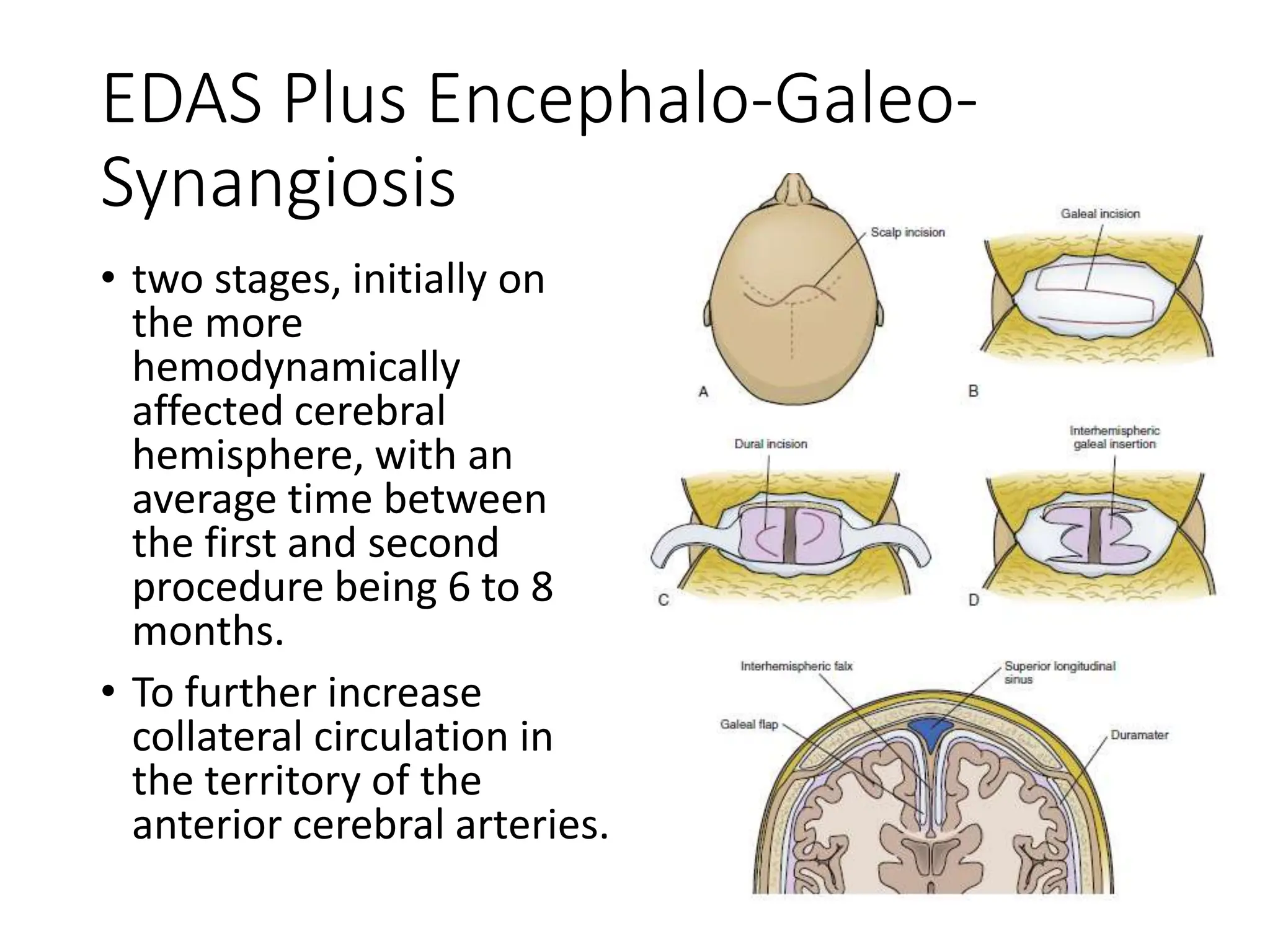 Moya Moya disease (vasculopathy/angiopathy) | PPTX | Brain and Nervous ...