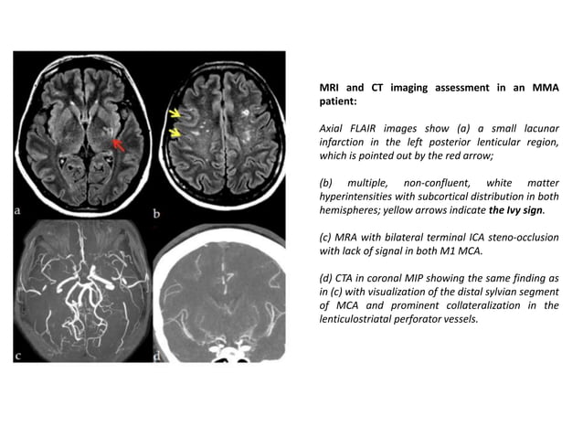 Moya Moya disease (vasculopathy/angiopathy) | PPTX | Brain and Nervous ...