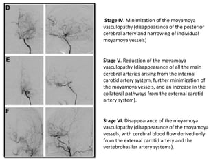 Moya Moya disease (vasculopathy/angiopathy) | PPTX