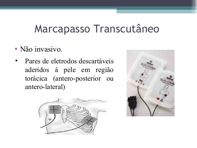 Estimulação Cardíaca Artificial