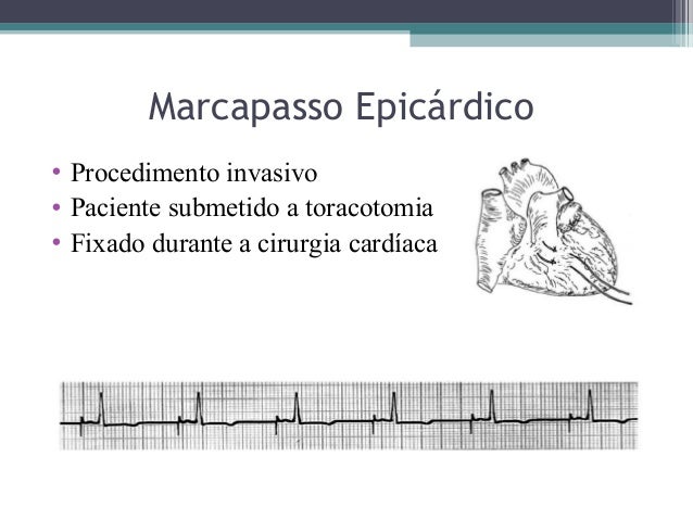 Estimulação Cardíaca Artificial