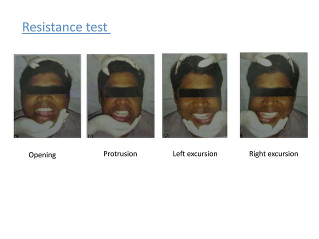 Mpds (Myofacial pain dysfunction syndrome) | PPTX | Physical Therapy ...