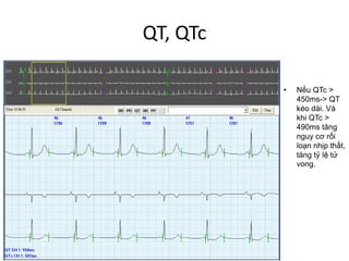 ĐỌC KẾT QUẢ HOLTER ĐIỆN TÂM ĐỒ 24 GIỜ | PDF