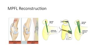 Medial patellofemoral ligament injuries and management | PPT